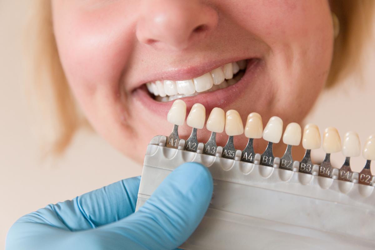 Benefits Of Dental Veneers Dental Veneers Pasadena Texas